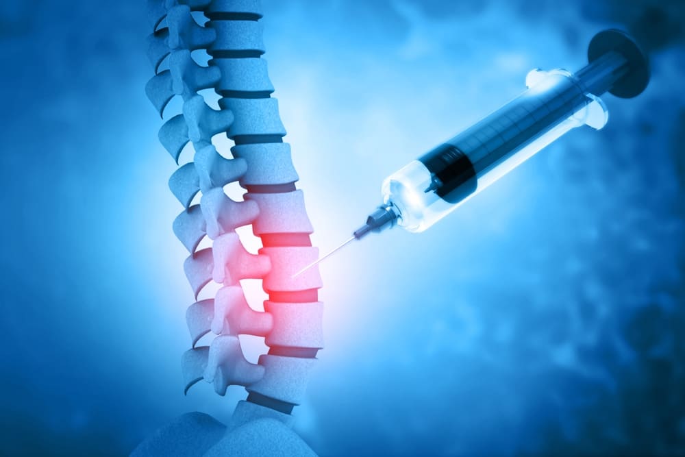 Inyecciones epidurales lumbares: Una solución no quirúrgica para el dolor lumbar - New York ...